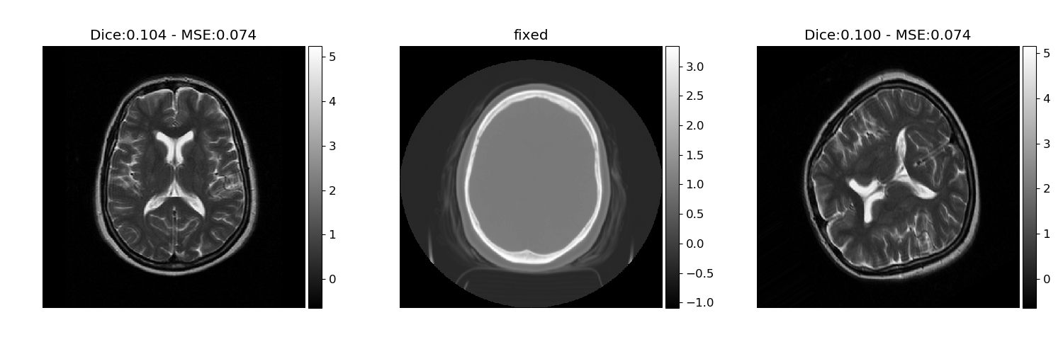 The Affine model with MI is not satisfying for CT/MR co-registration · Issue #164 · voxelmorph ...