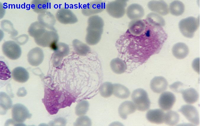 سلول های خونی و ناهنجاری های انها